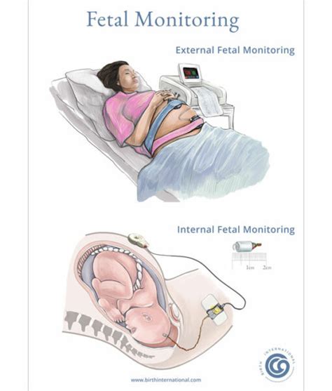 Fetal Monitoring Birth International Fetal Monitoring Birth International