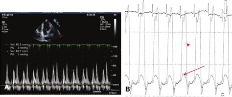 A Cyclic Variation In Mitral Inflow During Respiration A Marked Download Scientific Diagram
