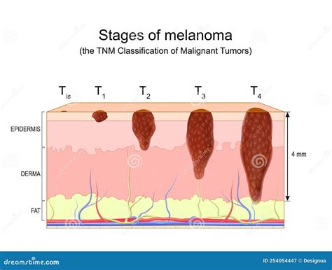 Stages Of Melanoma The Tnm Classification Of Malignant Tumors Stock