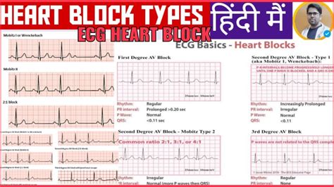 Heart Blocks Ecg Quiz At Leona Freedman Blog