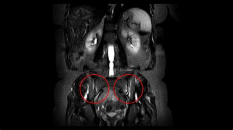 Patient Case Study Sacroiliitis