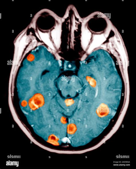 Brain Cancer Coloured Axial Horizontal Magnetic Resonance Imaging Mri Scan Through The Head