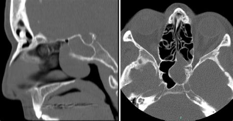 A 55 Year Old Woman With Ngh In The Sphenoid Sinus Axial And Sagittal
