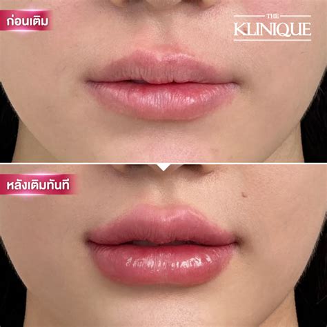 ฉีดฟิลเลอร์ปาก เคล็ดลับสวยสะดุดตาสะกดใจหนุ่ม ๆ Theklinique