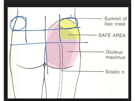 Gluteal Im Injection