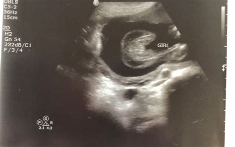Ambiguous Genitalia Ultrasound