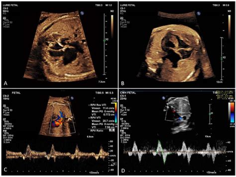 Utility Of Fetal Echocardiography With Acute Maternal Hyperoxygenation Testing In Assessment Of