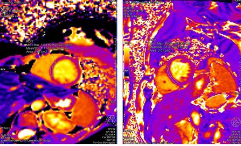 An Example Of Native T1 A And T2 B Mapping In A Healthy Volunteer