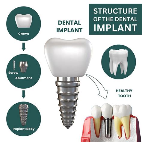 Partial Dentures Vs Implants Choosing The Right Solution For Tooth