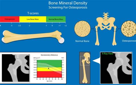T Score Chart For Bone Density Unified Premier Womens Care