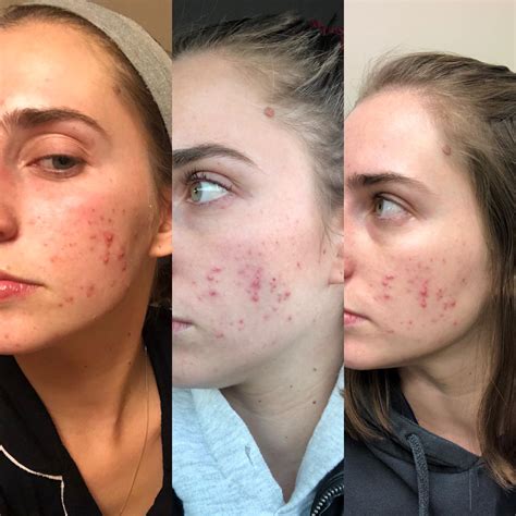 No Purging With Tretinoin At Patricia Mack Blog