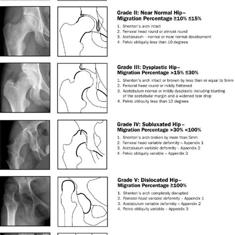 Radiographs And Diagrams Showing The Hip Classification System In Download Scientific Diagram