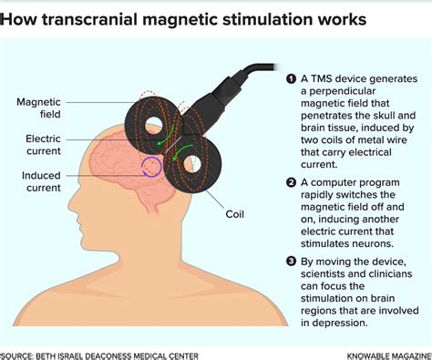 Mentalhealth Tms Transcranialmagneticstimulation Mentalhealthawareness Depressiontreatment