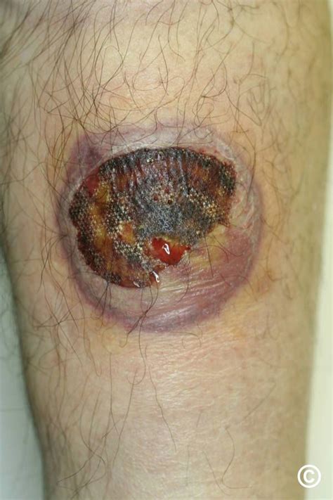 Pyoderma Gangrenosum