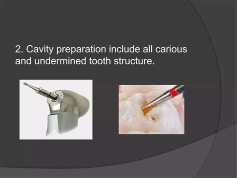 Modifications Of Class 2 Cavity Preparations Pptx Oral Care Personal Care