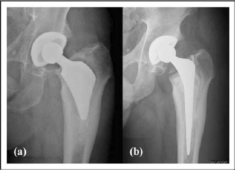 Table 1 From The Depuy Proxima™ Short Stem For Total Hip Arthroplasty