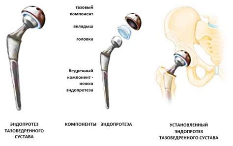 Основные принципы выбора эндопротеза тазобедренного сустава Болезни суставов позвоночника и