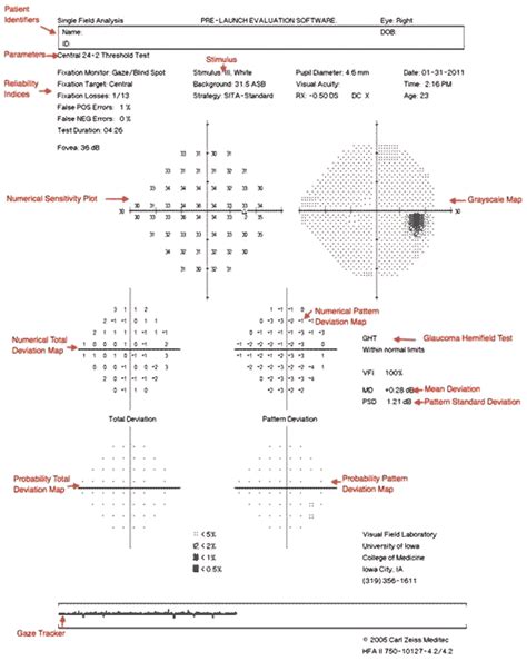 Visual Field Testing From One Medical Student To Another