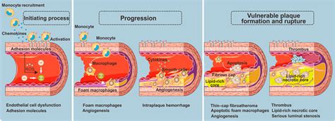 Atherosclerosis Process