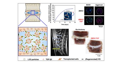Intervertebral Disc Regeneration Using Stem Cellgrowth Factor Loaded Porous Particles With A