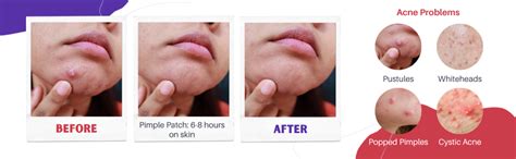 Pimple Patches Ance Patch Spot Patches Acne Patches Star Spot Patches Ance Treatment