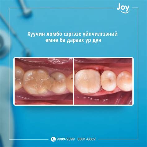 Шvд цоорох өвчин гэдэг нь шvдний Joy Dent шүдний эмнэлэг