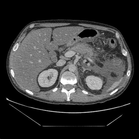 Radiopaedia Case Acute Pancreatitis Id 7171 Study 8144 Nc Commons
