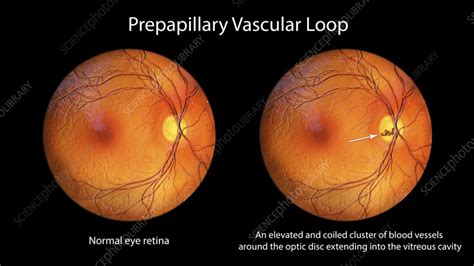 Prepapillary Vascular Loop On The Retina Illustration Stock Image F0403989 Science Photo Prepapillary Vascular Loop On The Retina Illustration Stock Image F0403989 Science Photo