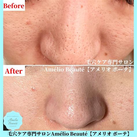 フラクショナルレーザーで毛穴治療をしたら毛穴のボコボコや開き毛穴は変わる 群馬県太田市 東京都渋谷区表参道 凸凹毛穴開き毛穴すり鉢