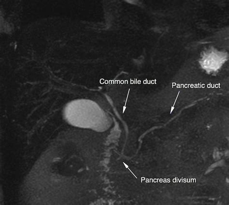 Congenital Pancreatic And Biliary Anomalies Body Mri