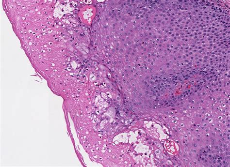 Pathology Outlines Esophagitis Dissecans Superficialis