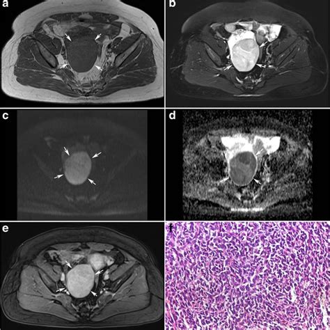 Magnetic Resonance Imaging Of A Large Ovarian Tumor Arrows A Axial