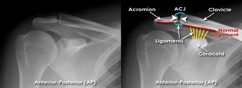 Acromioclavicular Joint Dislocation X Ray