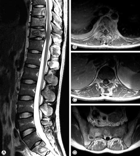 Initial Thoracolumbar Spine Mri Sagittal T2 Weighted I Open I