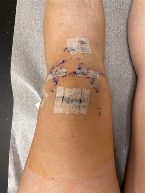 Before And After 1 Day Post Op Acl Revision R Acl