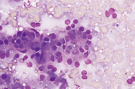 Hepatocellular Carcinoma Cytology