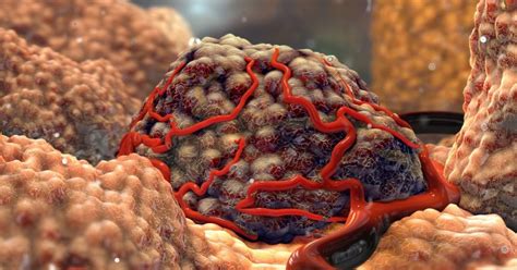 Todo Tumor é Câncer Braincp