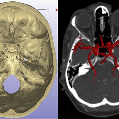 3d Reconstruction Three Dimensional Rendering Of Segmented Bone A