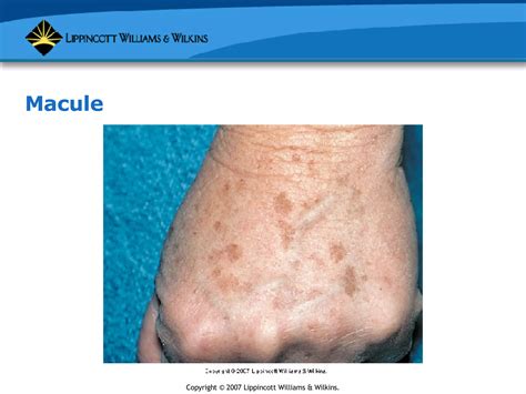 Soft Tissue Lesions Ppt