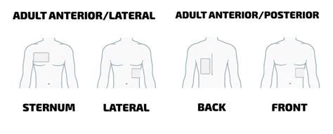 Optimum Method For Defibrillation Pad Placement Intelesens