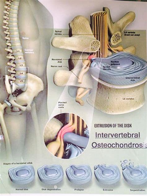 Нурууны мэдрэлийн гаралтай өвчин ЭРҮҮЛ ЭНХ БАЯС эмнэлэг