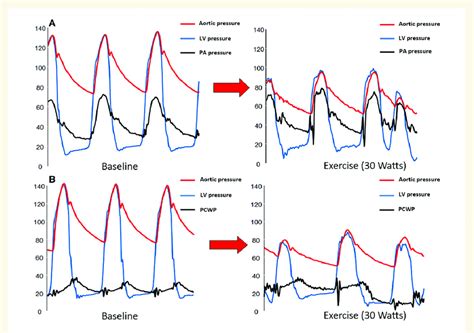 Pulmonary Arterial Pressure And Pulmonary Capillary Wedge Pressure