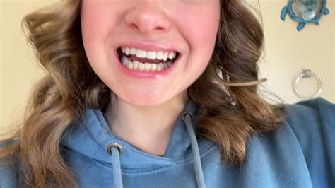 Random Gap After Braces Scrolller Random Gap After Braces Scrolller