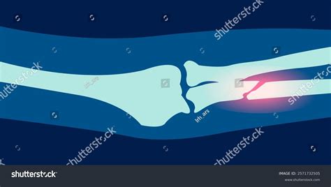 X Ray Image Forearm Fracture Illustration 2d Stock Vector Royalty Free