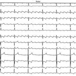 An Example Of A Counter Clockwise Atrial Flutter With Negative F Waves Download Scientific