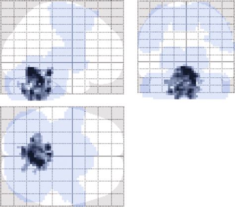 General Connectivity Increase In Cerebellum And Brainstem After Download Scientific Diagram