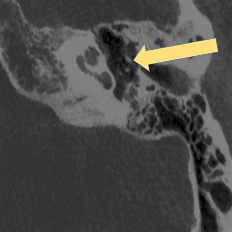 Cbct For Temporal Bones The New Gold Standard Cavendish Imaging