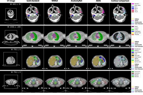 A Deep Learning Based Auto Segmentation System For Organs At Risk On Whole Body Computed