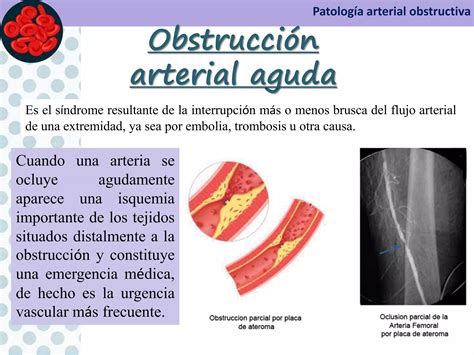 Patología Vascular Arterial Obstructiva Ppt