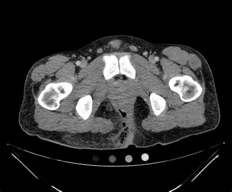 Fournier S Gangrene On Ct At Nickole Williams Blog